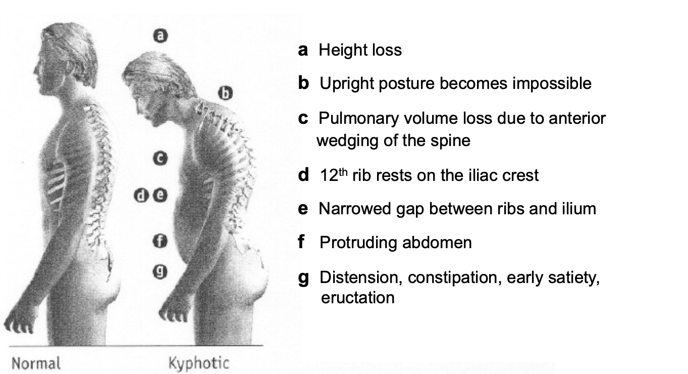 Cheltenham Spine Clinic Osteoporotic Vertebral Compression Fractures